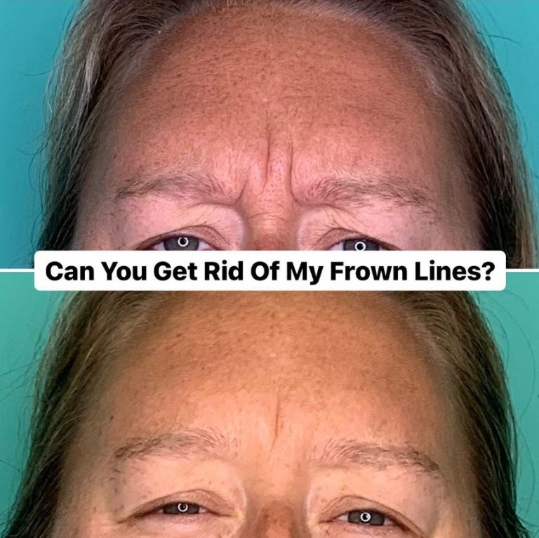 Can You Get Rid Of My Frown Lines? – The Babington Clinic
